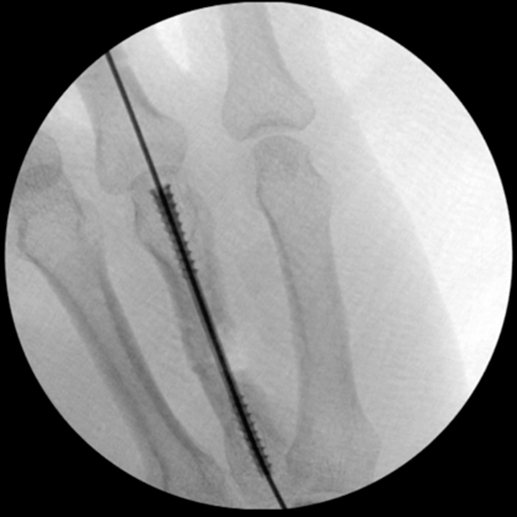 NX Nail fixation of 4th Metcarpal. ORIF for correction of malunion